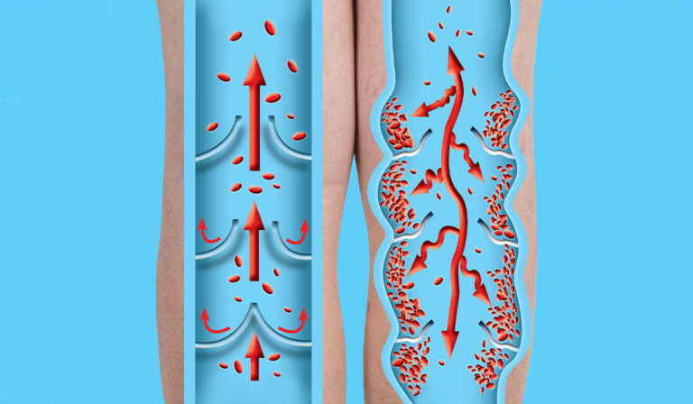 Edema: What Is, Causes, Symptoms, and Treatment