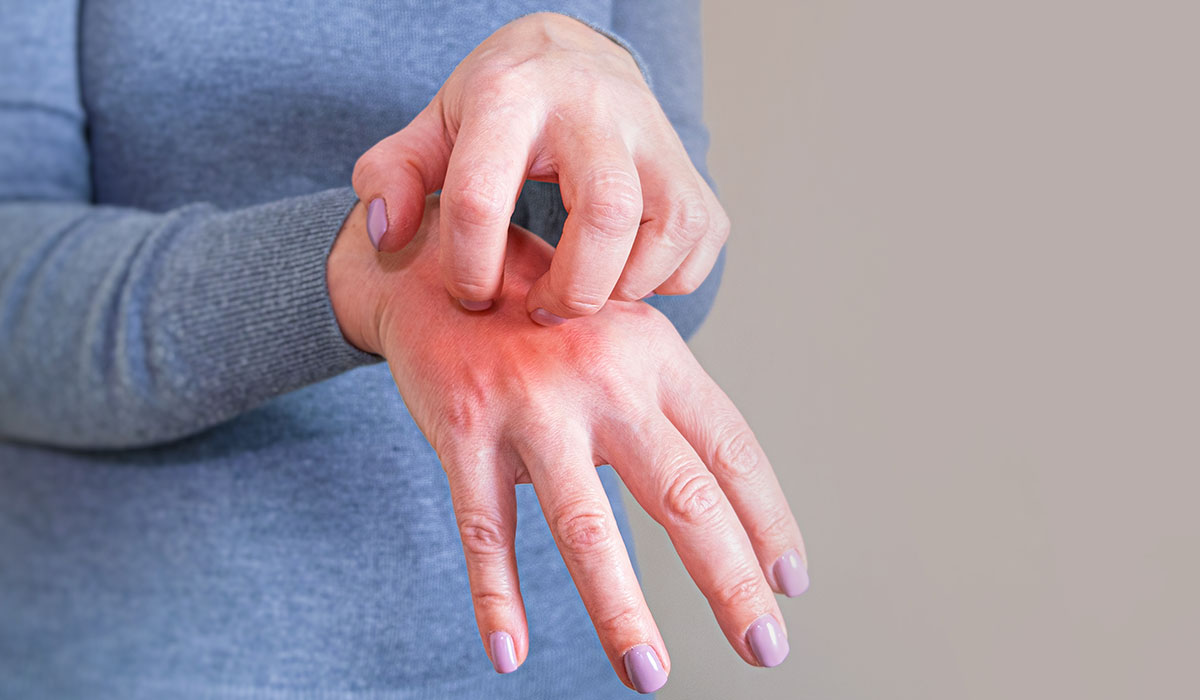 Scabies: What is, Symptoms, Treatment, Prevention, and Useful Facts