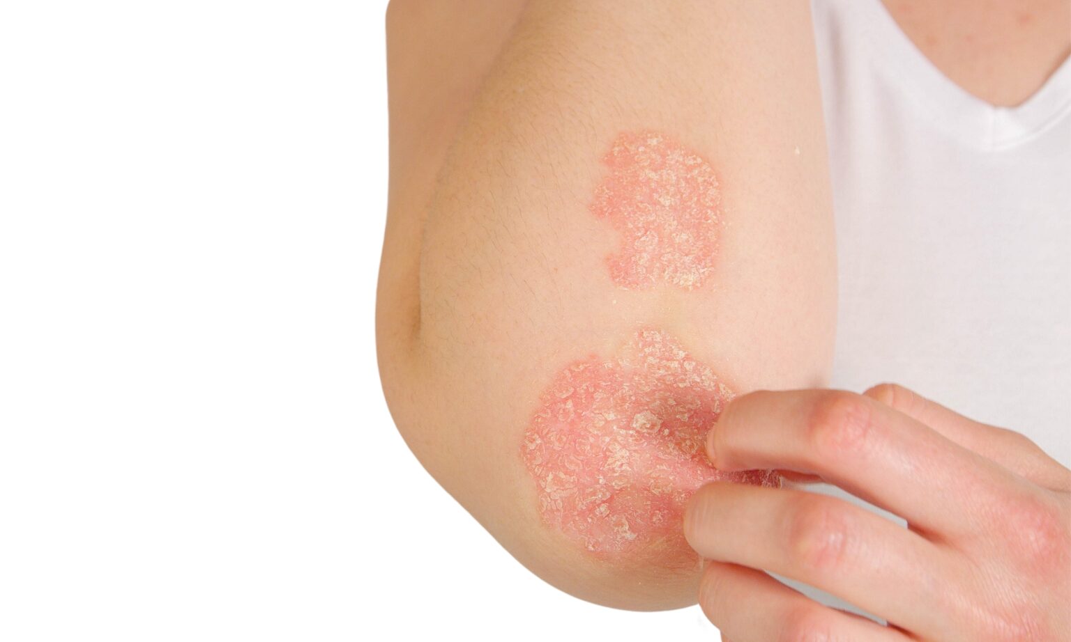 Psoriatic Arthritis What Is Symptoms Diagnosis And Treatment 9403