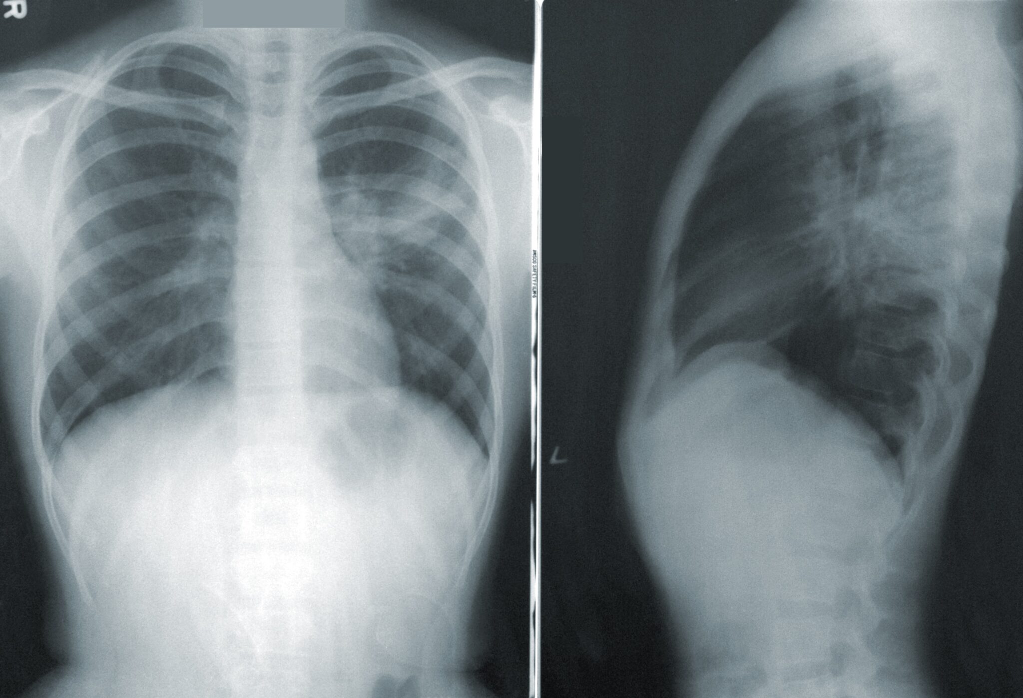 Hypercapnia: What Is, Risks, Causes, Levels, and Symptoms