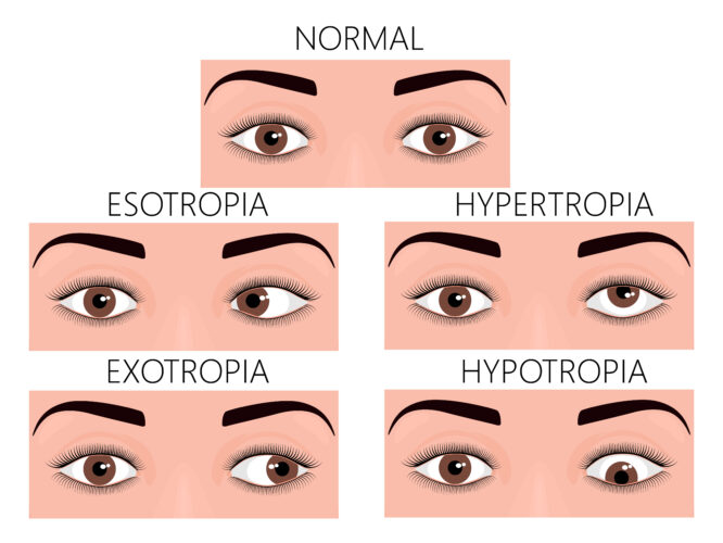 Strabismus : Types, Causes – WARRMX