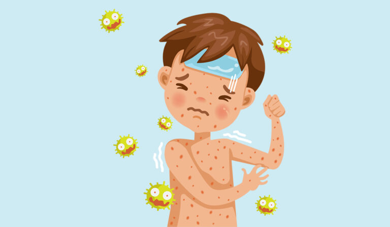 Typhus: What Is, Types, Causes, Symptoms, and Treatment
