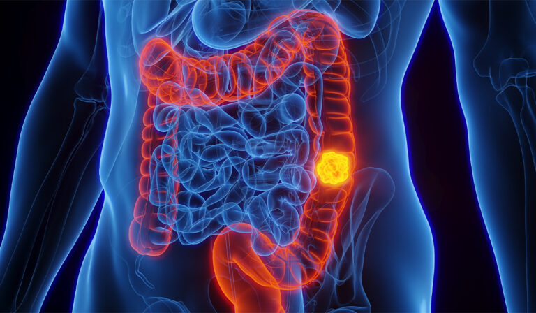 Colon: What Is, Functions, Diseases, and Prevention