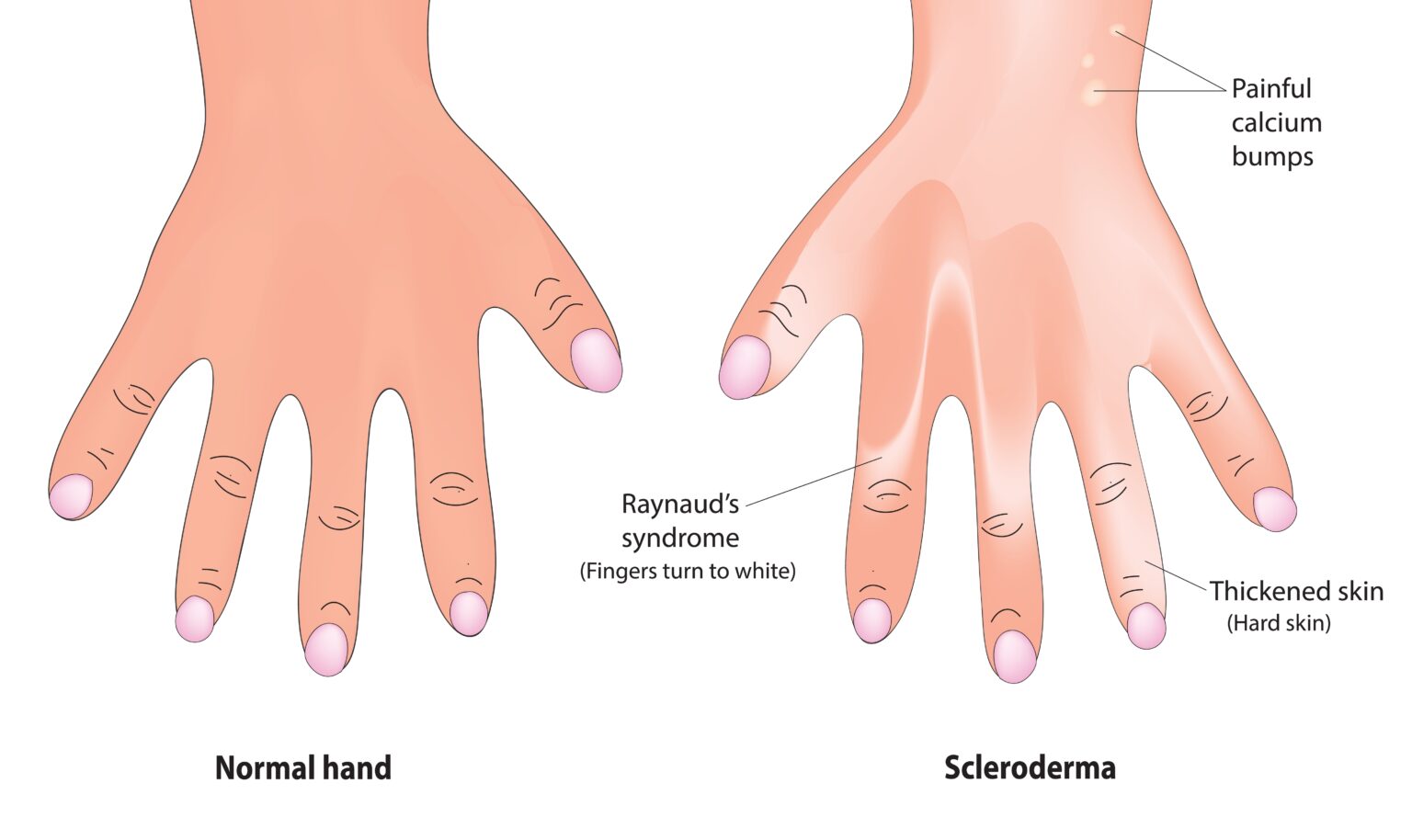 Scleroderma: What Is, Types, Causes, Symptoms, and Diagnosis